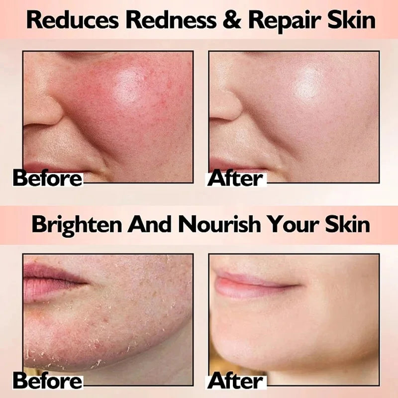 Facial Redness Repair Serum Against Redness Rosacea Spider Vein Treatm ...