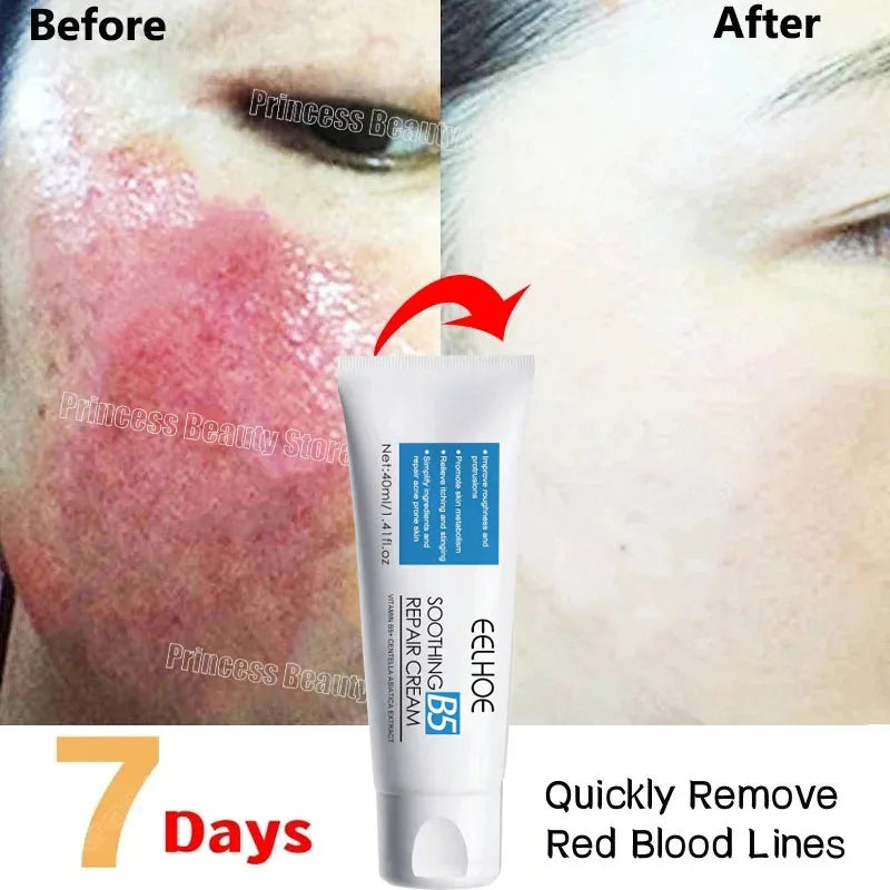 Facial Redness Repair Cream – Soothing Moisturizer for Sensitive & Dry ...